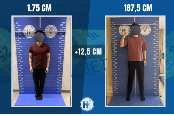 Lon Method (.com) - What Is Lon Method ? - Limb Lengthening Turkey